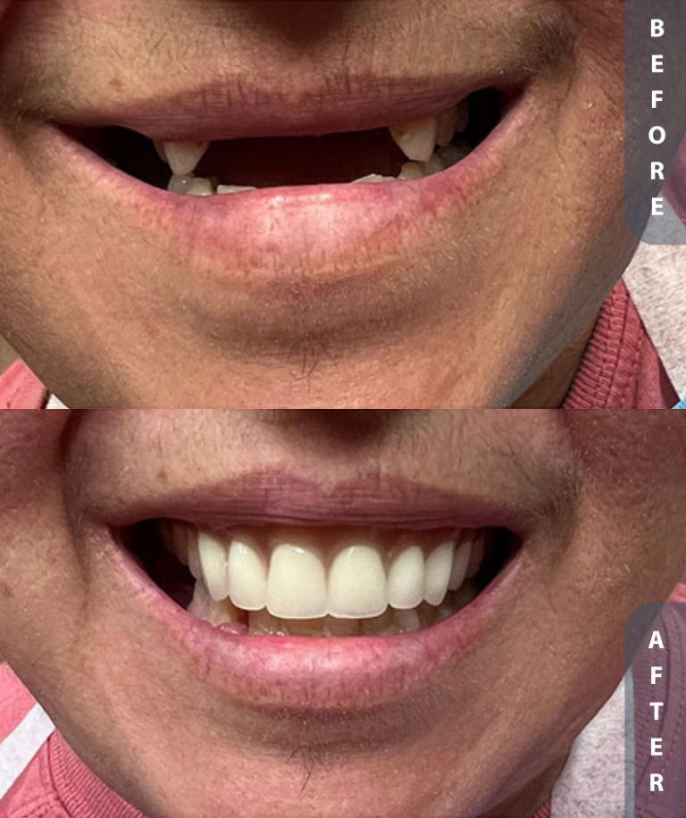 Smile Gallery – Secure Dental