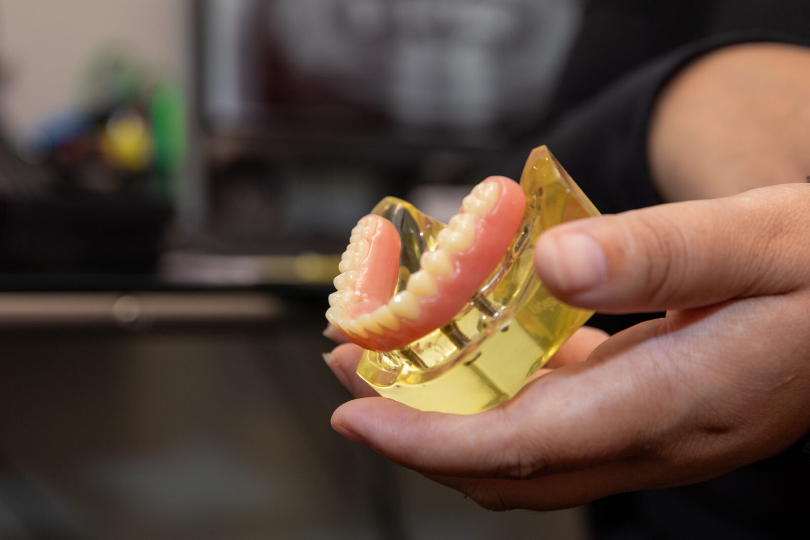 Snap-In Dentures: Enhancing Stability and Function – Secure Dental