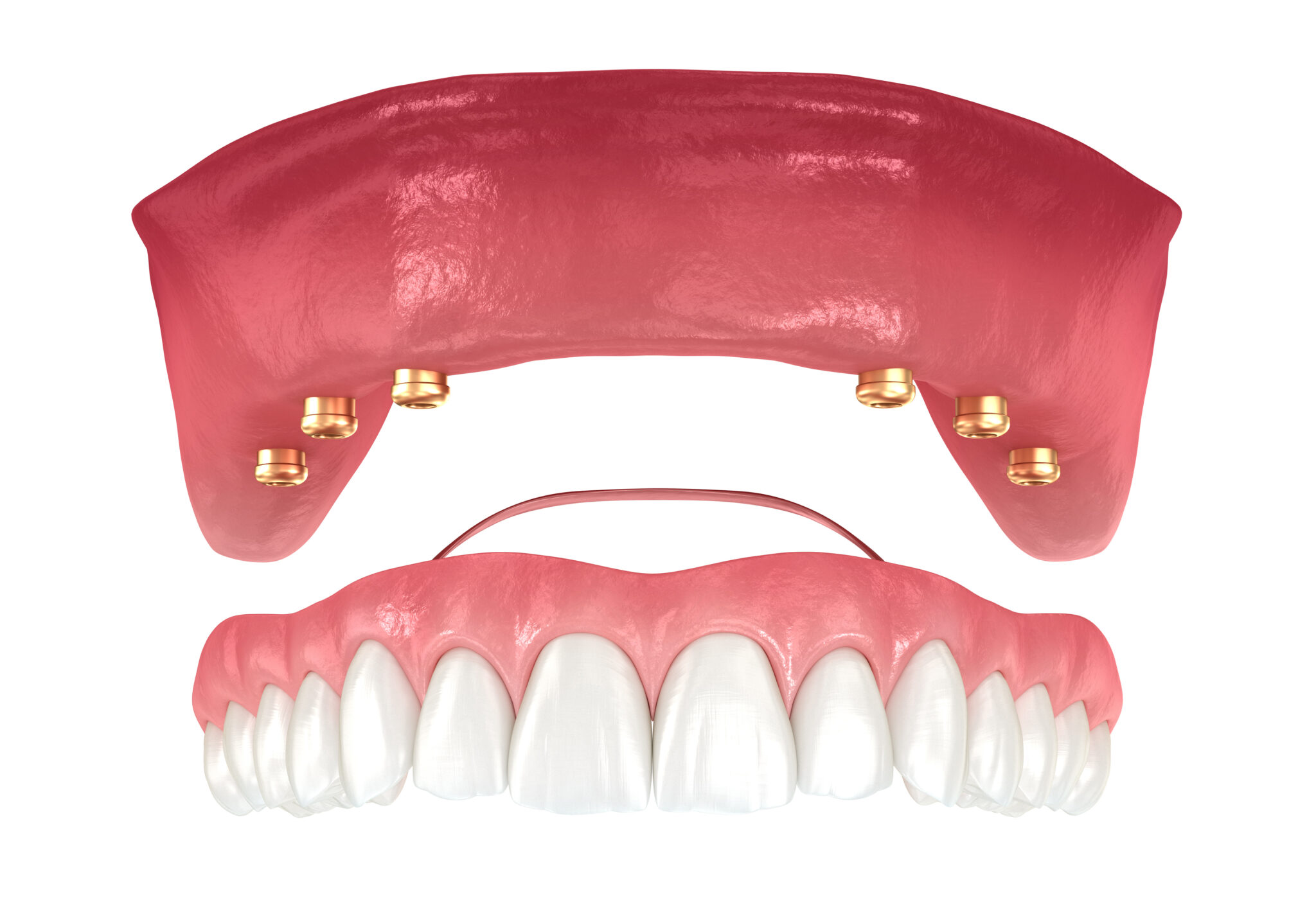 Snap-In Dentures: Enhancing Stability and Function – Secure Dental