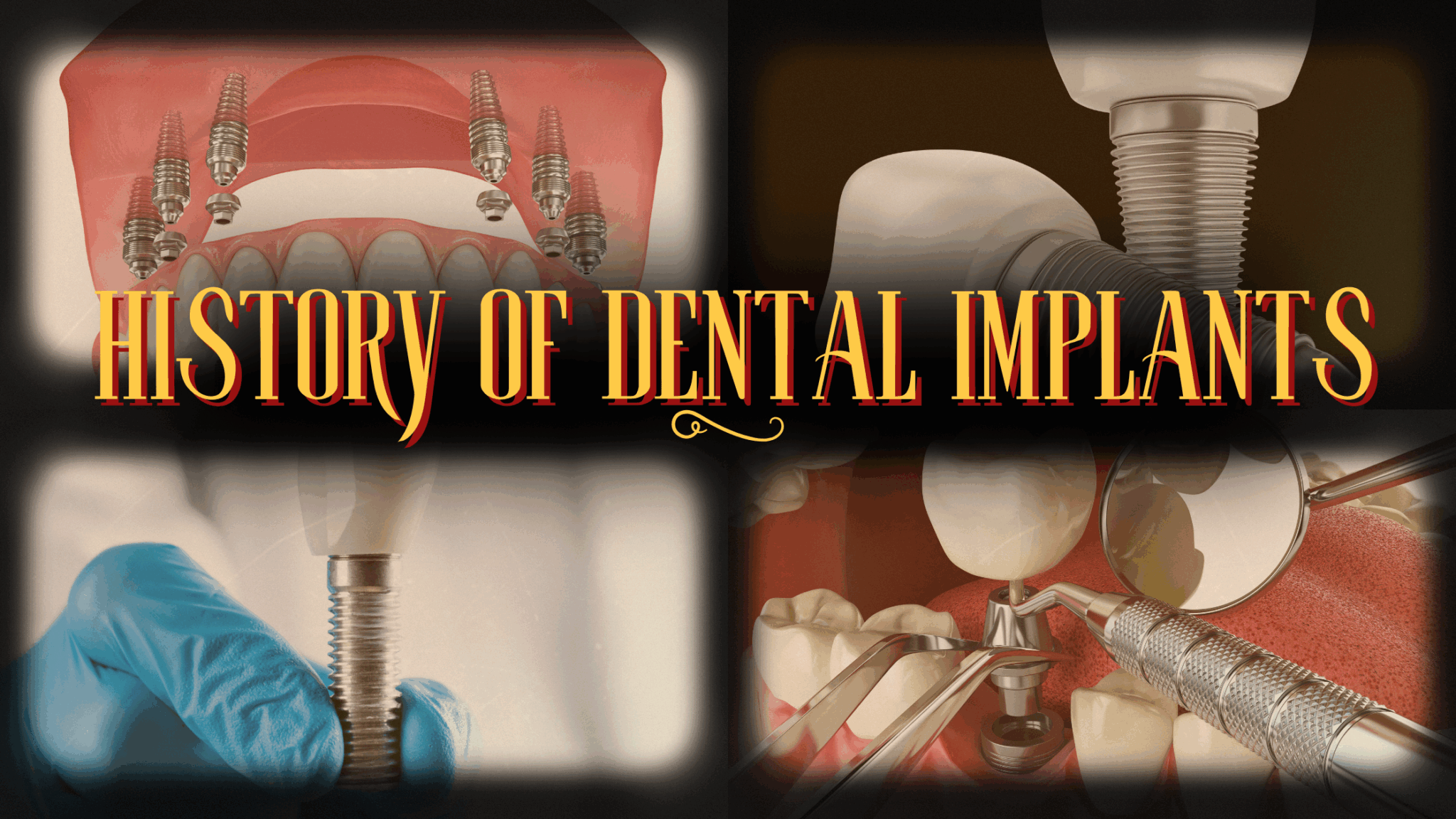 The Evolution of Dental Implants: A Historical Perspective – Secure Dental
